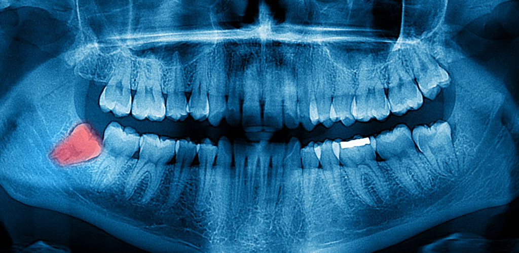 Catching oral cancer in its earliest stages - Dental Health Partners